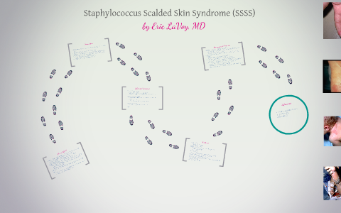Staphylococcus Scalded Skin Syndrome (SSSS) by Eric LaVoy on Prezi