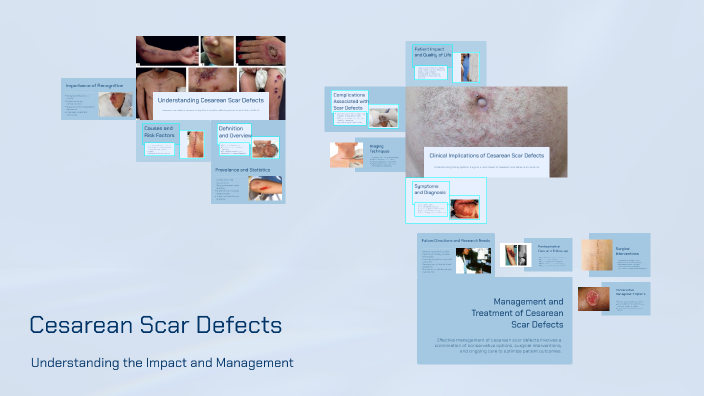 Cesarean Scar Defects by Corey Sermer on Prezi
