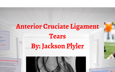 ACL Tears Jackson Plyler by Jackson Plyler on Prezi