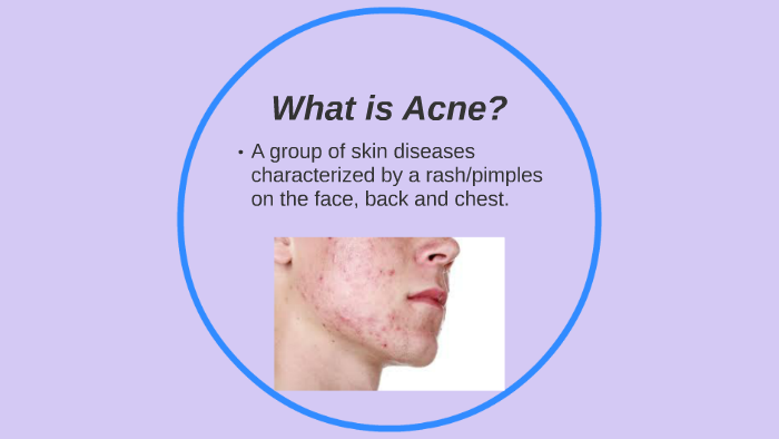 What is Acne? by Madison Duclos on Prezi