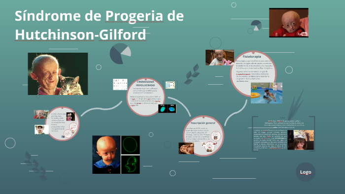 Síndrome de Progeria de Hutchinson-Gilford by jesus alberto mendoza ...