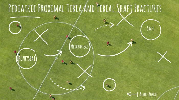Pediatric Proximal Tibia and Tibial Shaft Fractures by Aimee Bobko on Prezi