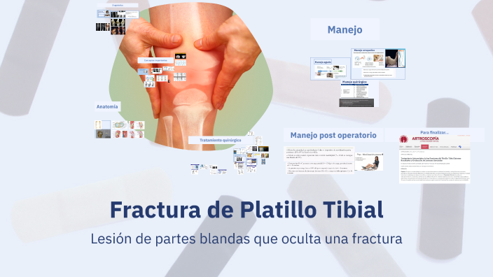 Fractura de Platillo Tibial by ALEXANDER BURGA on Prezi