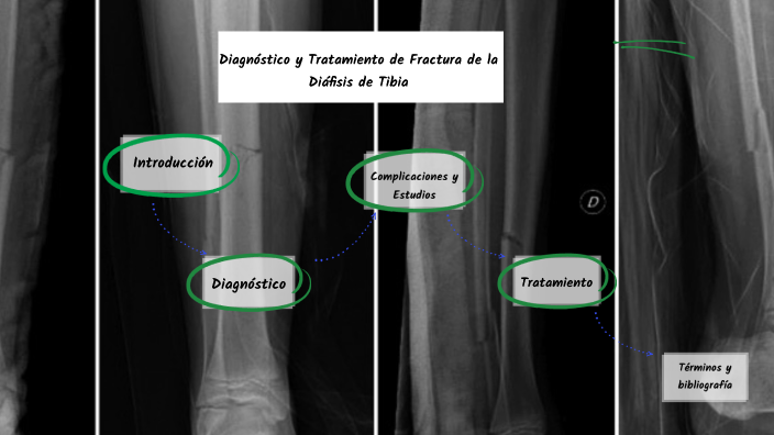 Diagnostico y Tratamiento Fractura de la Diáfisis de Tibia by Candela ...