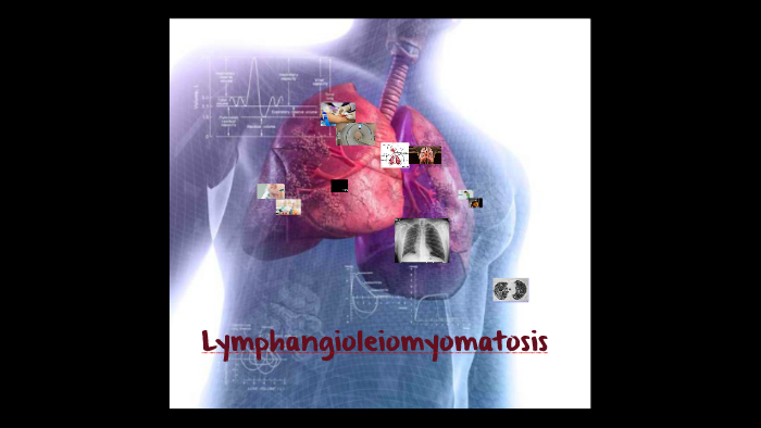 Image result for lam disease symptoms by Milaurie Quinones on Prezi
