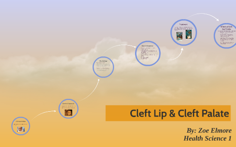 Cleft Lip & Cleft Palate by Zoe Elmore on Prezi