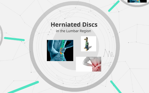 Herniated Discs Tory Cavanagh by Victoria Cavanagh on Prezi