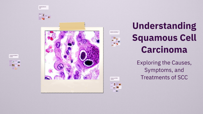 Understanding Squamous Cell Carcinoma by Landon Romero on Prezi
