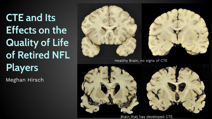 CTE and Its Effects on the Quality of Life of Retired NFL Players ...