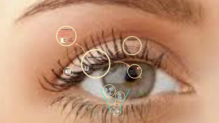 QUERATOPLASTIA by edna burgos on Prezi