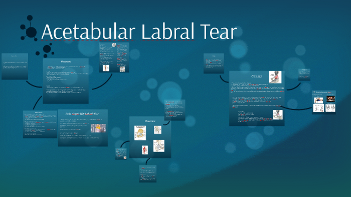 Acetabular Labral Tear by emilie dahl on Prezi