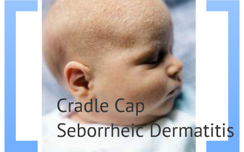 Cradle Cap/ Seborrheic Dermatitis by Kelsey Takacs on Prezi