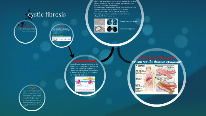 cystic fibrosis by loulou ch on Prezi
