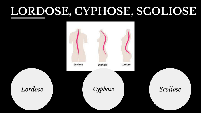 Lordose, cyphose, scoliose by maelys boukhari on Prezi