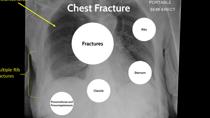 Chest Fracture by Alyssa Thomas on Prezi