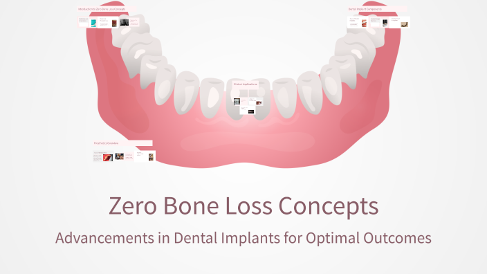 Zero Bone Loss Concepts by 正井 育 on Prezi