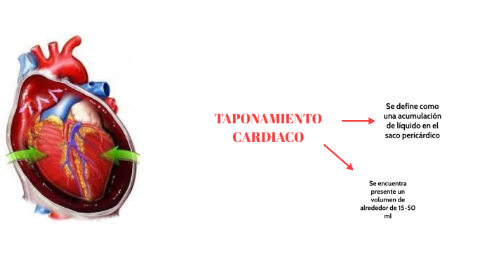 Taponamiento cardiaco by Juliana Munoz Velez on Prezi