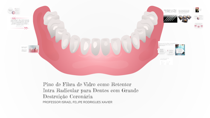 Pino de Fibra de Vidro como Retentor Intra Radicular para Dentes com ...