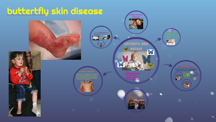 Butterfly skin disease by Dayana Katherine Alvarado Clavijo on Prezi