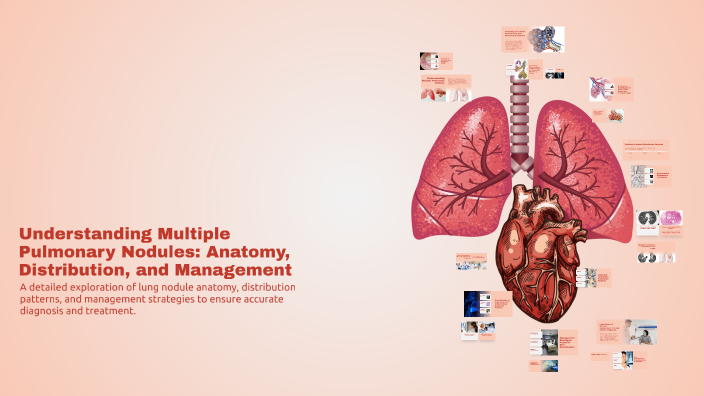 Understanding Multiple Pulmonary Nodules: Anatomy, Distribution, and ...