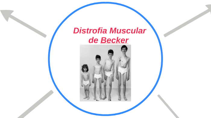 Distrofia Muscular de Becker by celeste vasquez cieza on Prezi