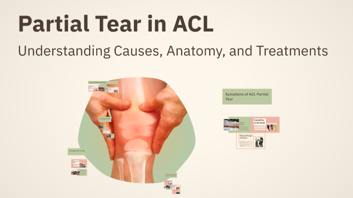 Partial Tear in ACL by Ελπίζω on Prezi