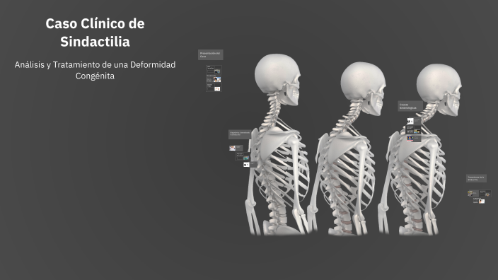 Caso Clínico de Sindactilia by Juan José Monteza Chávez on Prezi