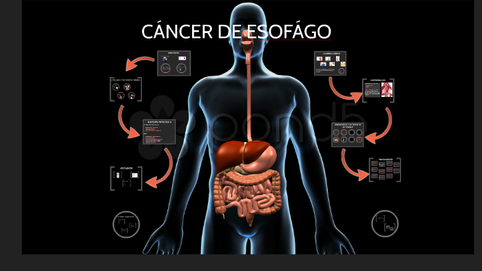CÁNCER DE ESOFÁGO by Isabel Ramirez on Prezi