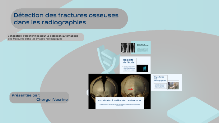 Détection des fractures osseuses dans les radiographies by Nesrine ...