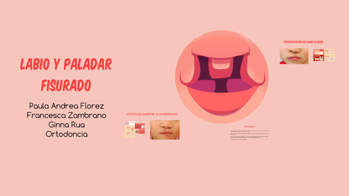 Labio y Paladar Fisurado by Paula Florez on Prezi