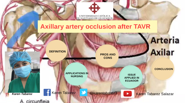 Axillary artery occlusion after TAVR by Karen Tabarez Salazar on Prezi