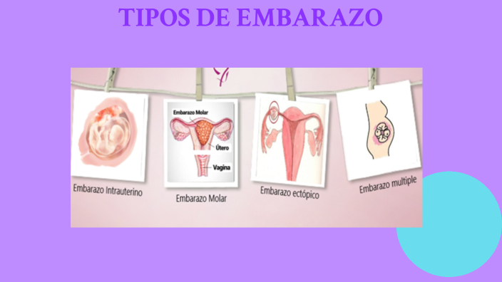 TIPOS DE EMBARAZO by MARISOL MARCELIANO on Prezi