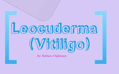 Vitiligo by bethany hightower on Prezi