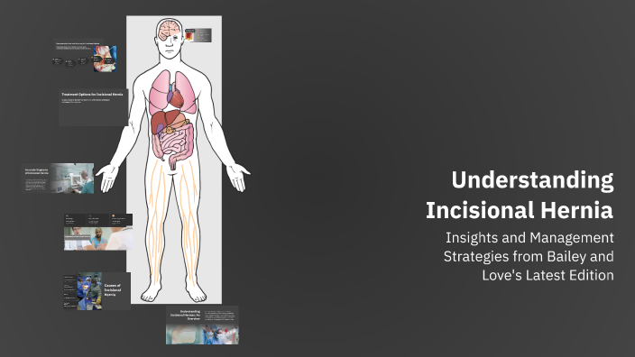 Understanding Incisional Hernia by Habibullah Jokhio on Prezi