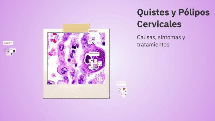 Quistes y Pólipos Cervicales by franzi donato on Prezi