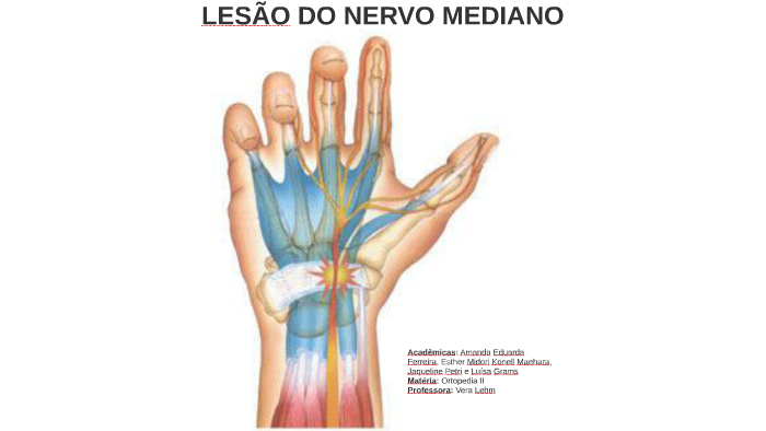 ORTO II - Lesão do nervo mediano - neurotmese by Esther Midori on Prezi