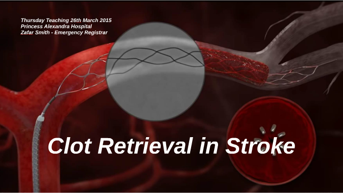 Clot Retrieval in Stroke by Zafar Smith