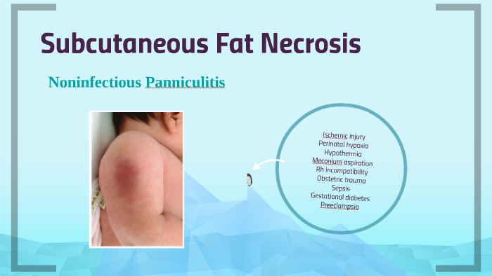 Subcutaneous Fat Necrosis Of The Newborn