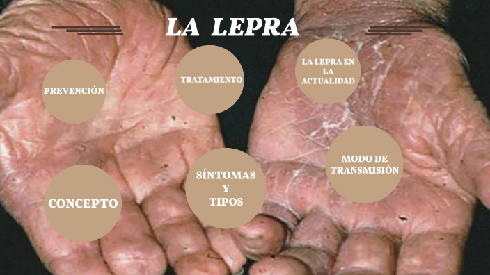 LA LEPRA by Lamia Mohamed Mohamed on Prezi