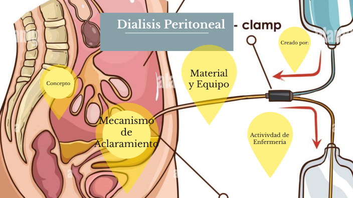 Dialisis Peritoneal By Jenifer Andrea Esmeralda García Rabarique On Prezi