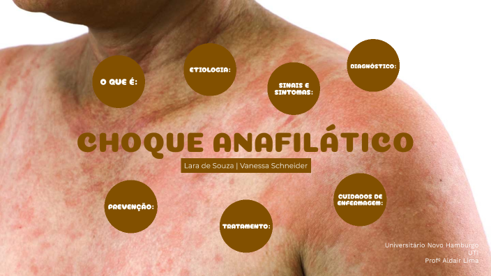 CHOQUE ANAFILÁTICO by on Prezi