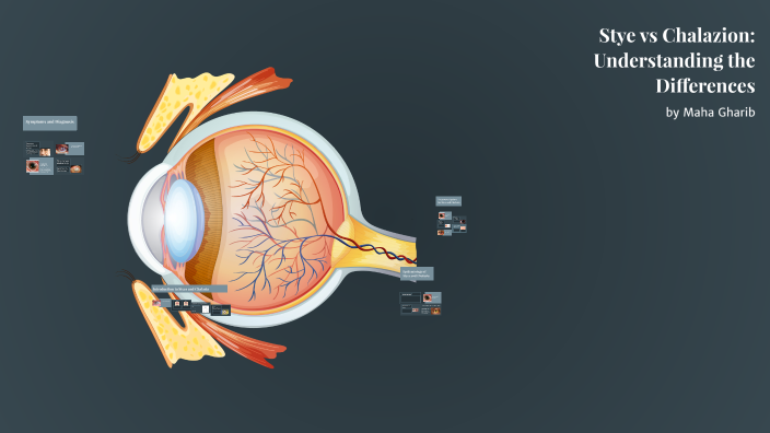 Stye vs Chalazion: Understanding the Differences by Maha Gharib on Prezi