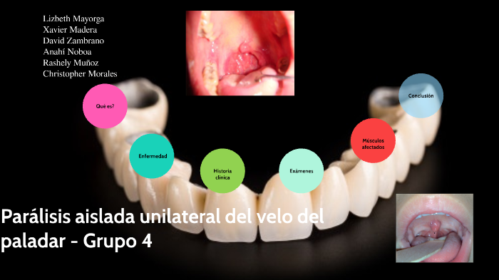 Parálisis aislada unilateral del velo del paladar by Matheus Wood on Prezi