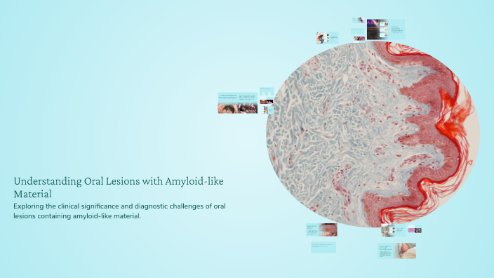 Understanding Oral Lesions with Amyloid-like Material by Lilian T on Prezi