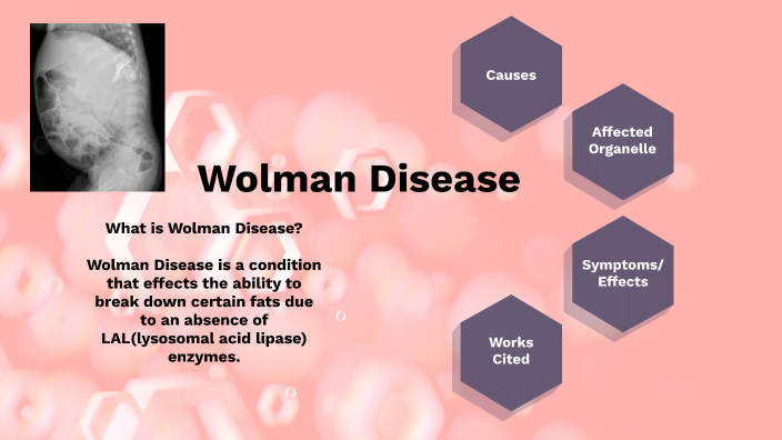 Wolman’S Disease Prognosis _ Maladie De Wolman Symptômes – KLTG
