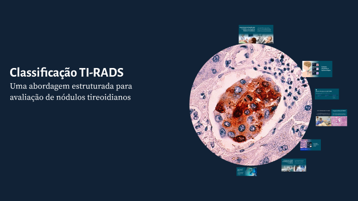 Classificação TI-RADS by Ruan Sates on Prezi