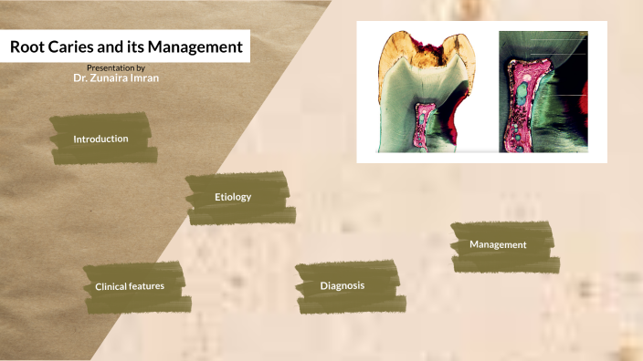 Root Caries and its Management by Zunaira Imran on Prezi