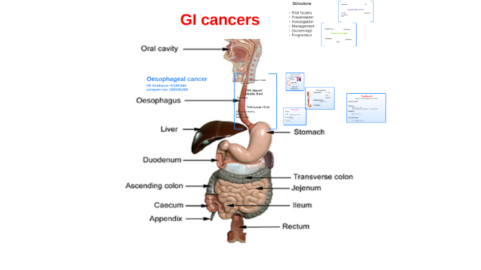 Upper GI cancers by Caoimhe Rice on Prezi