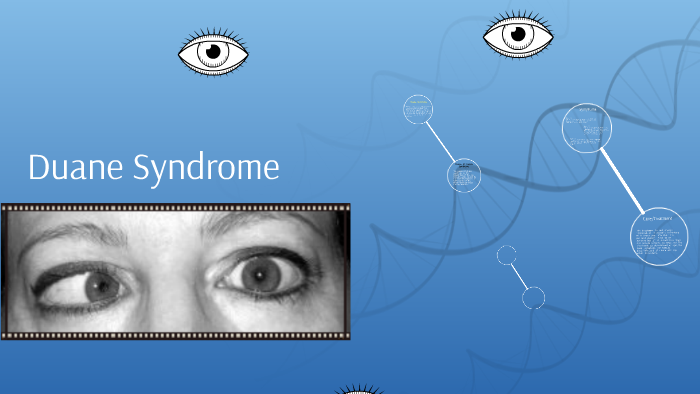 Duane Syndrome by Tara Key on Prezi