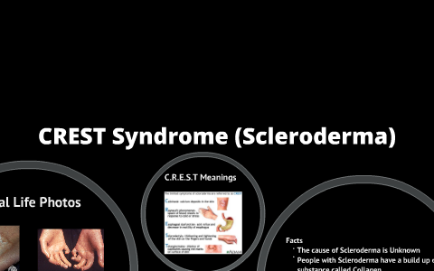 CREST Syndrome by Derek Bosworth on Prezi